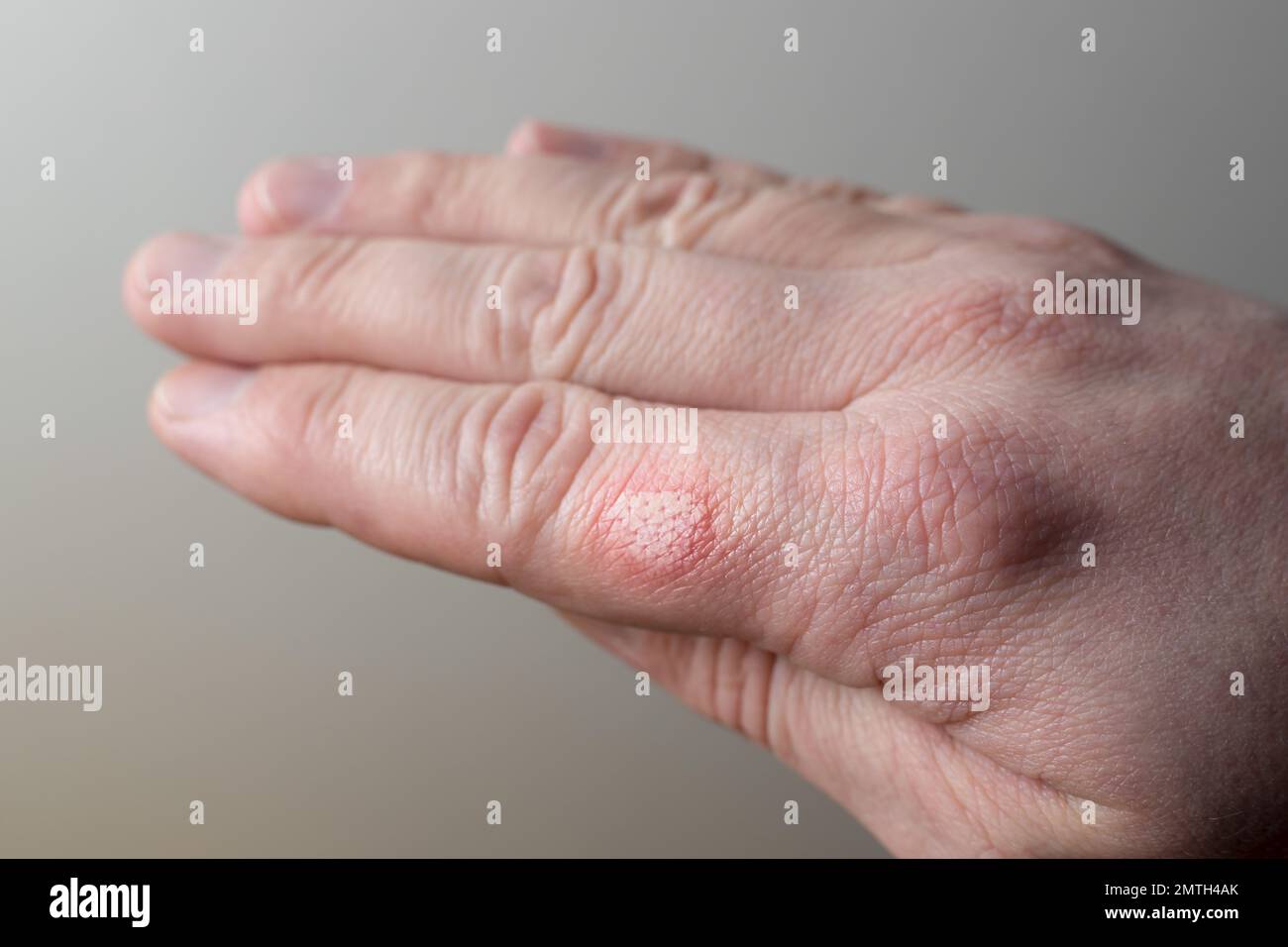 Burned finger hi-res stock photography and images - Alamy