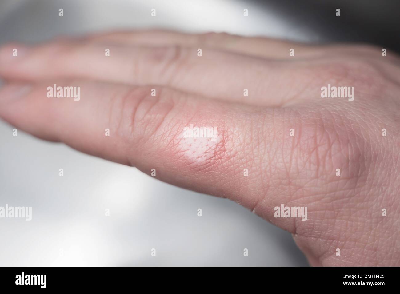 Burned skin on a finger of Caucasians man hand -close up Stock Photo ...