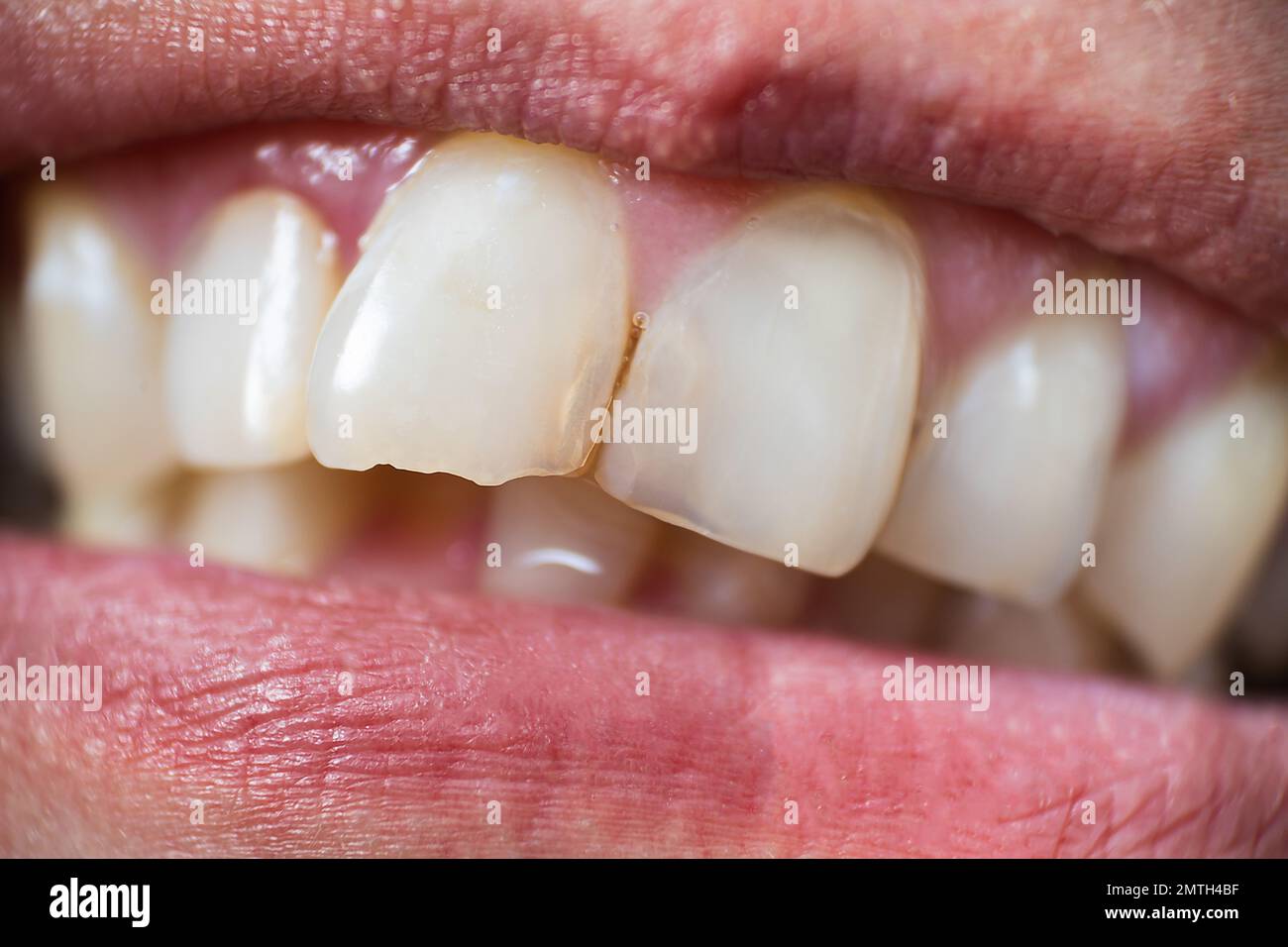 European male open mouth chipped front middle teeth Stock Photo - Alamy