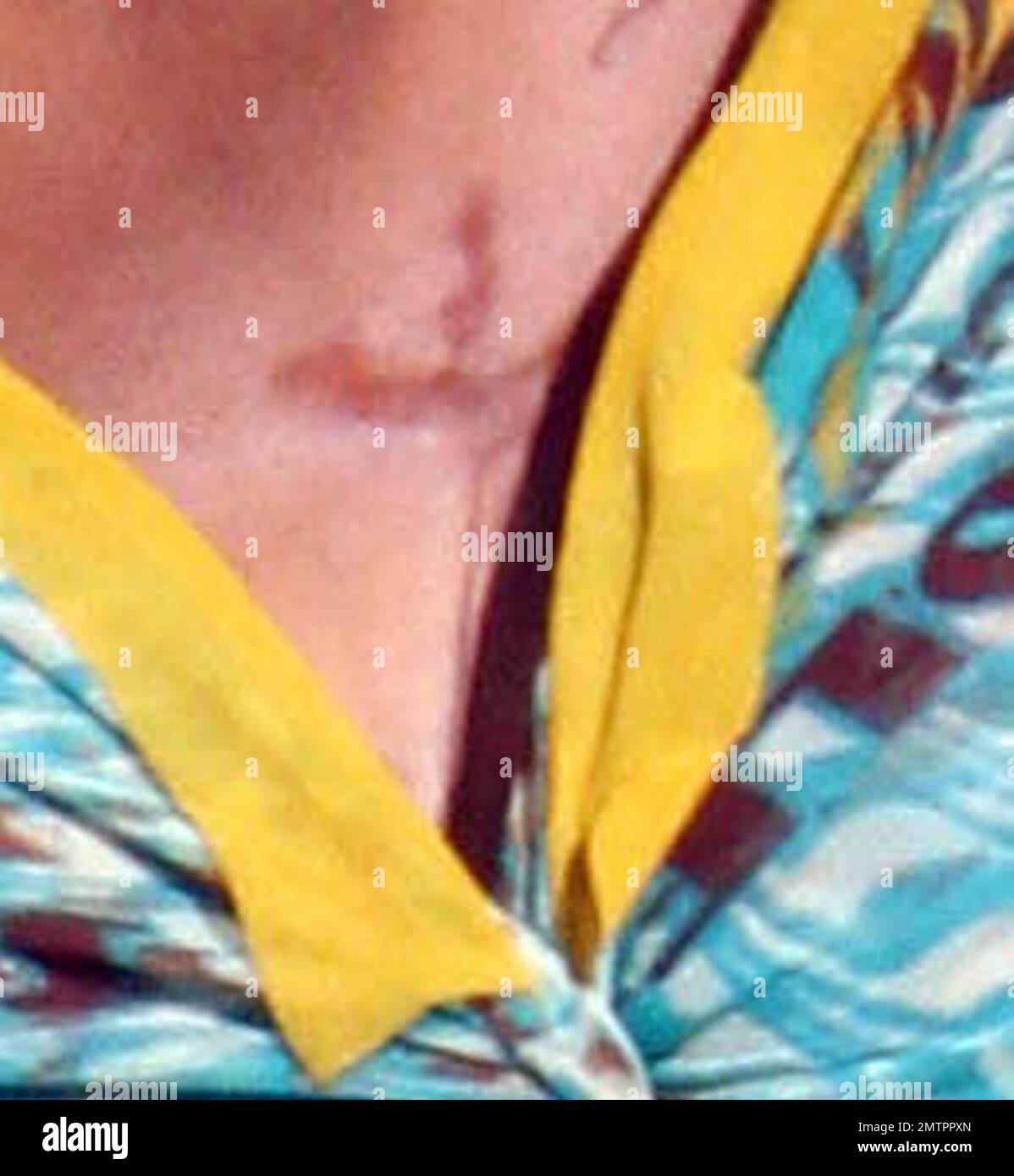 Heart surgery scar hi-res stock photography and images - Alamy