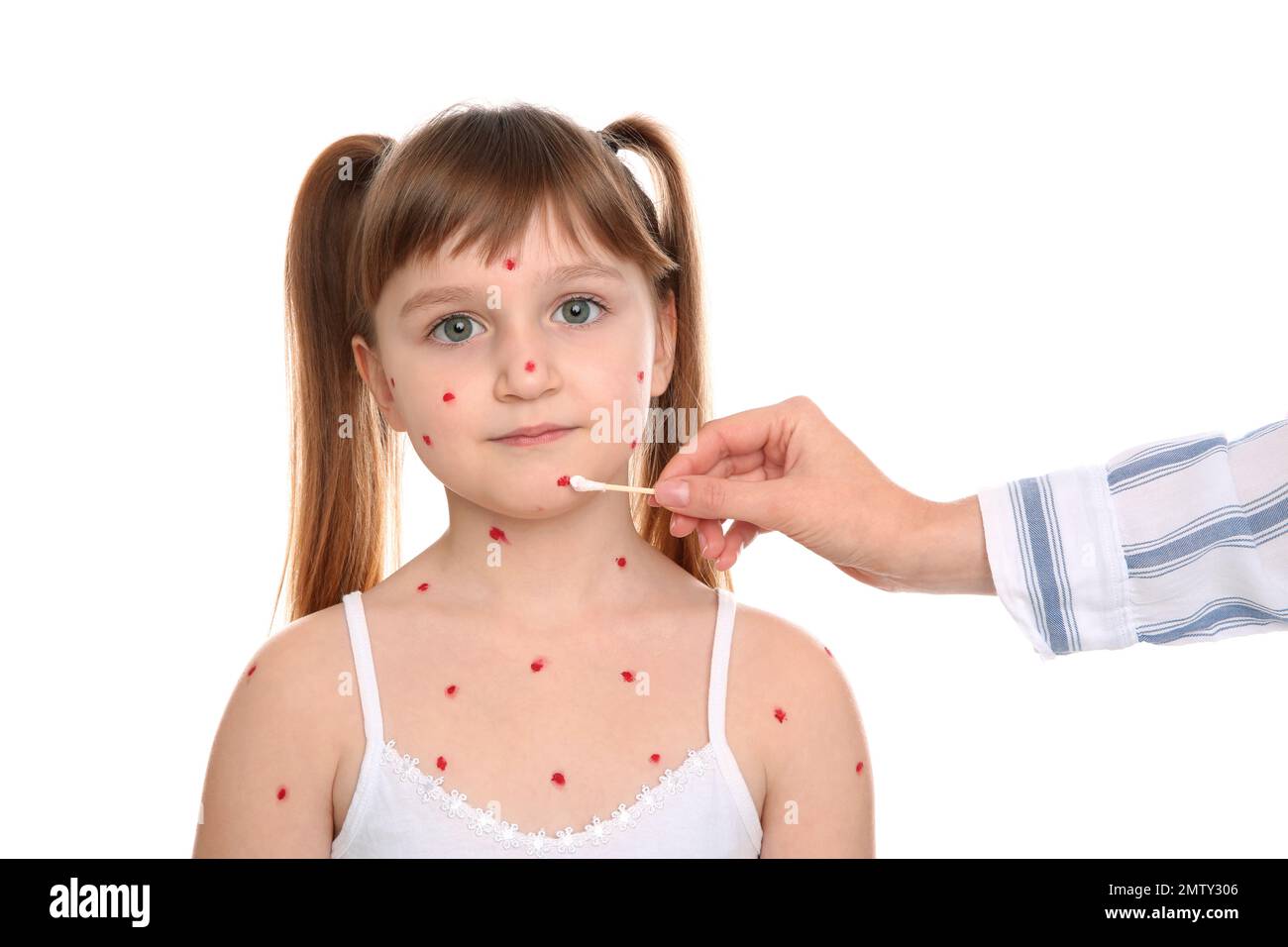 Woman applying cream onto skin of little girl with chickenpox on white ...