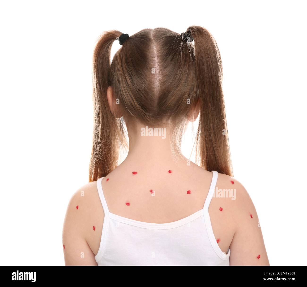 Little girl with chickenpox on white background Stock Photo - Alamy