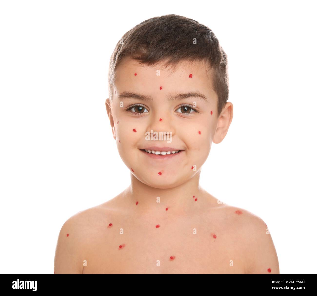 Little boy with chickenpox on white background Stock Photo - Alamy