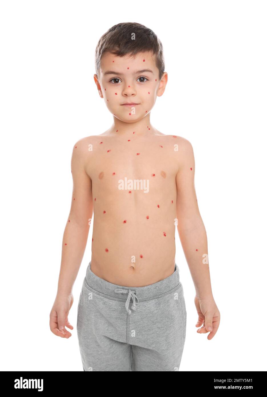 Little boy with chickenpox on white background Stock Photo - Alamy