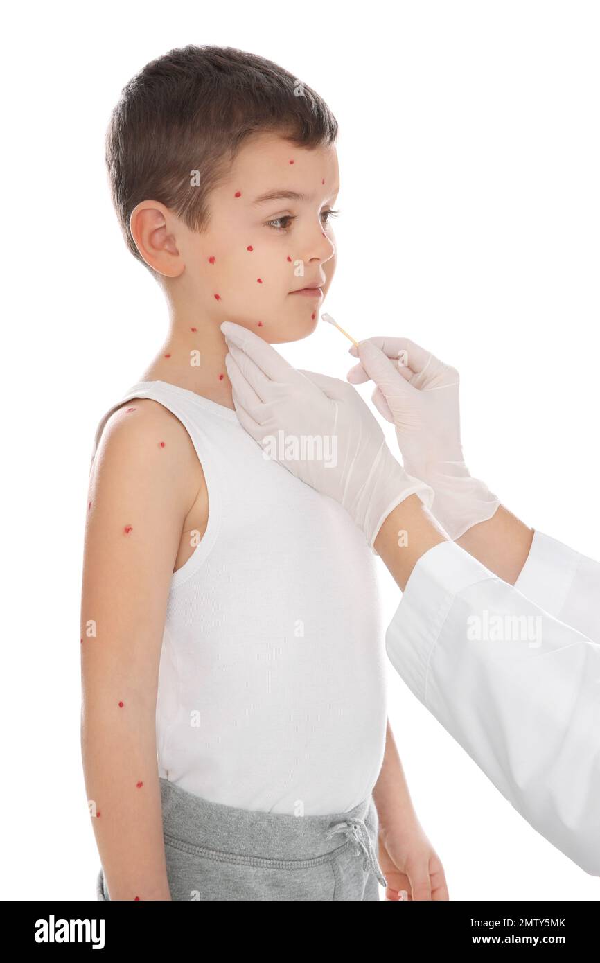 Doctor applying cream onto skin of little boy with chickenpox on white ...