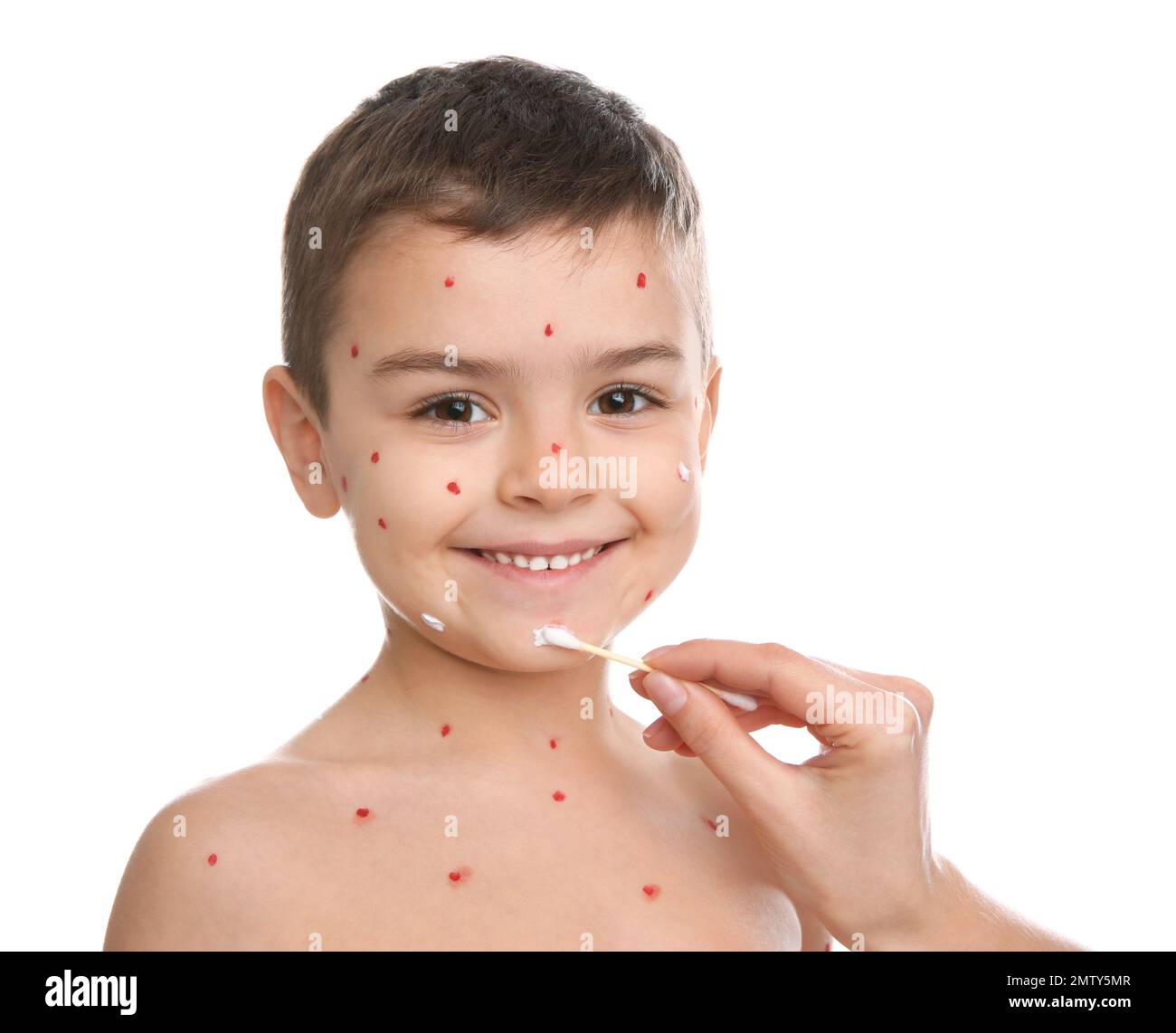 Woman applying cream onto skin of little boy with chickenpox on white ...