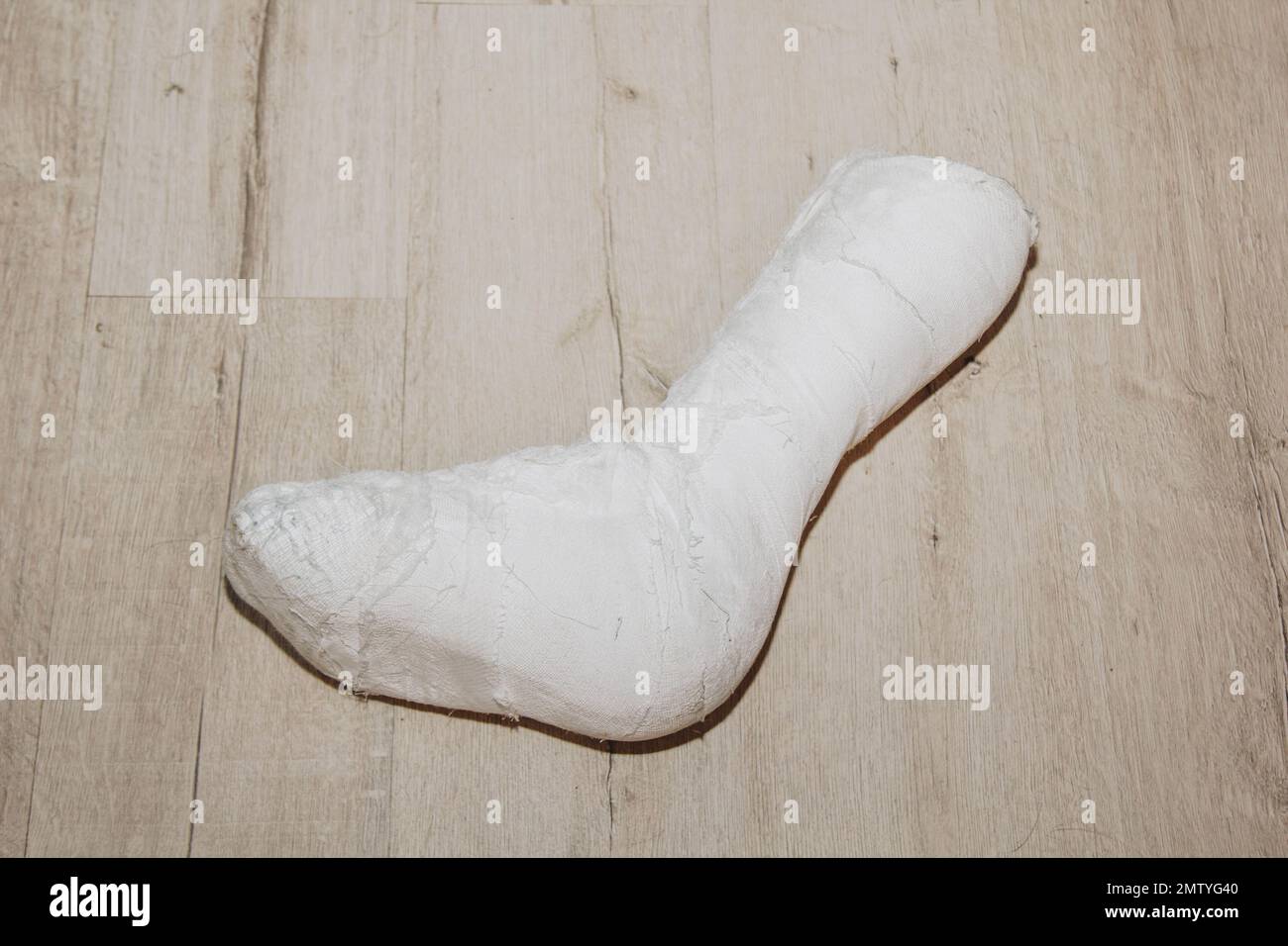 The cast removed from the leg lies on the floor as a symbol that the ...