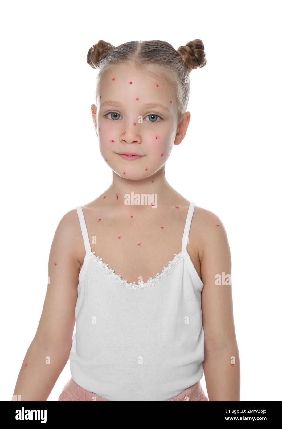 Little girl with chickenpox on white background. Varicella zoster virus ...
