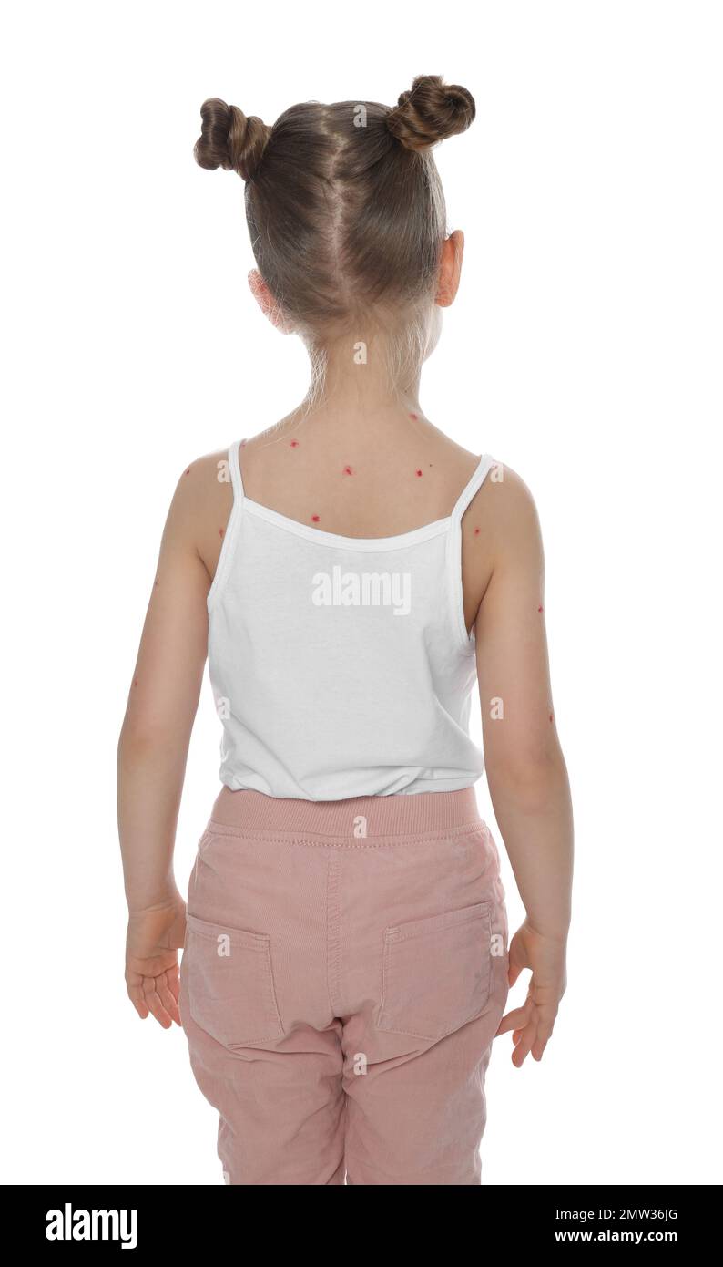 Little girl with chickenpox on white background. Varicella zoster virus ...