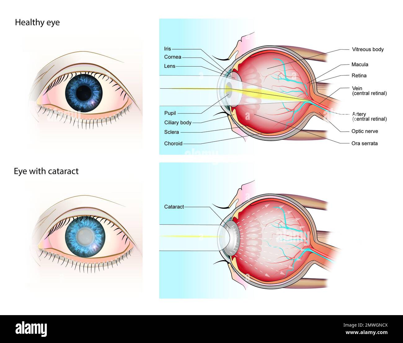 Normal eye and eye with cataract, illustration Stock Photo - Alamy