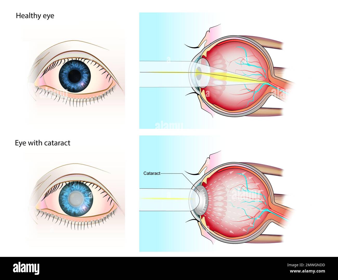 Normal eye and eye with cataract, illustration Stock Photo - Alamy