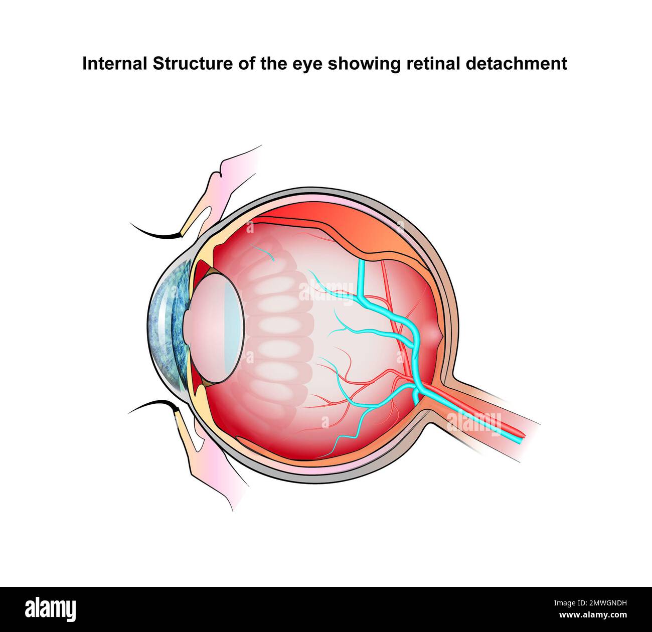 Retinal detachment, illustration Stock Photo - Alamy