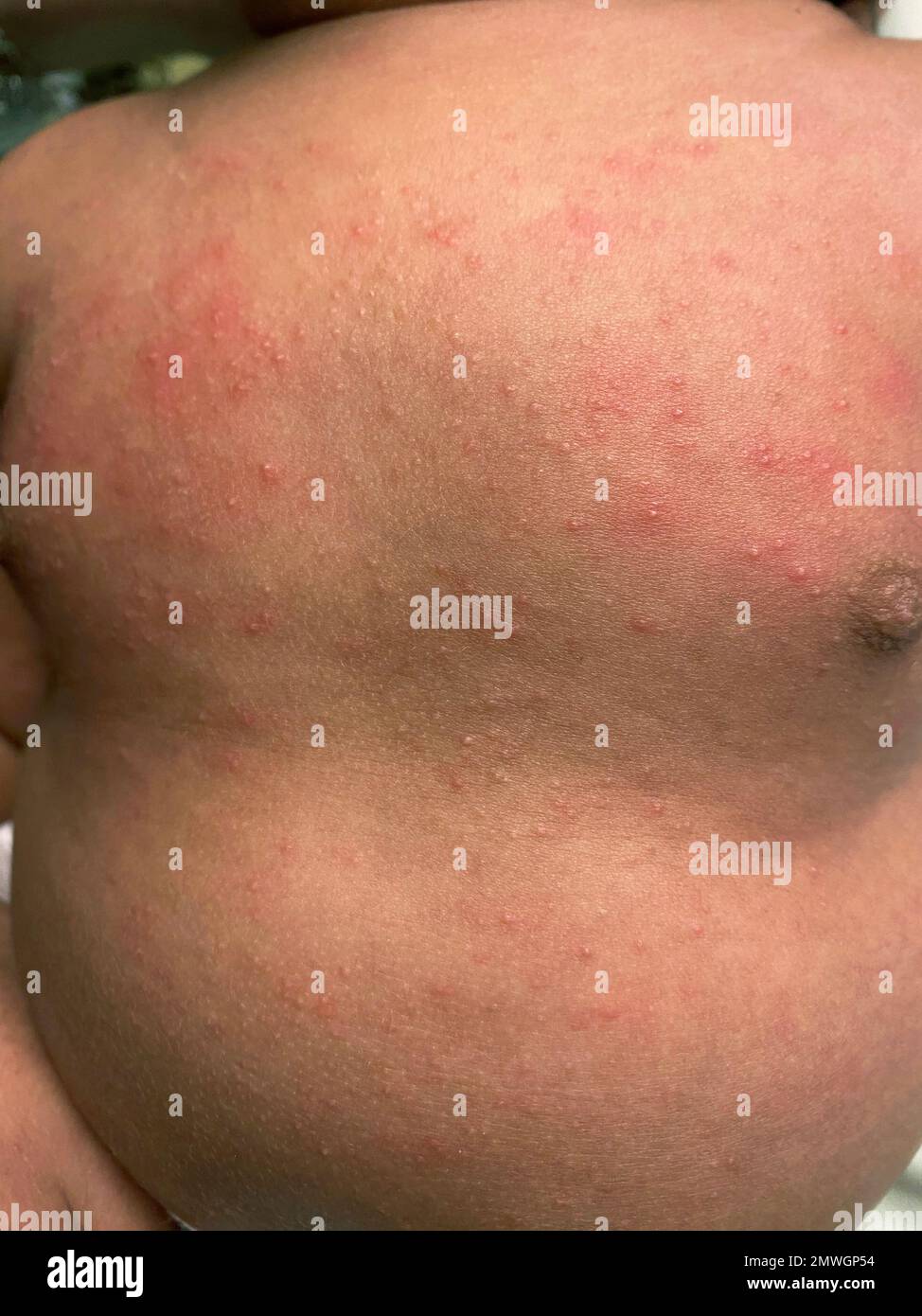 Neonatal Cephalic Pustulosis