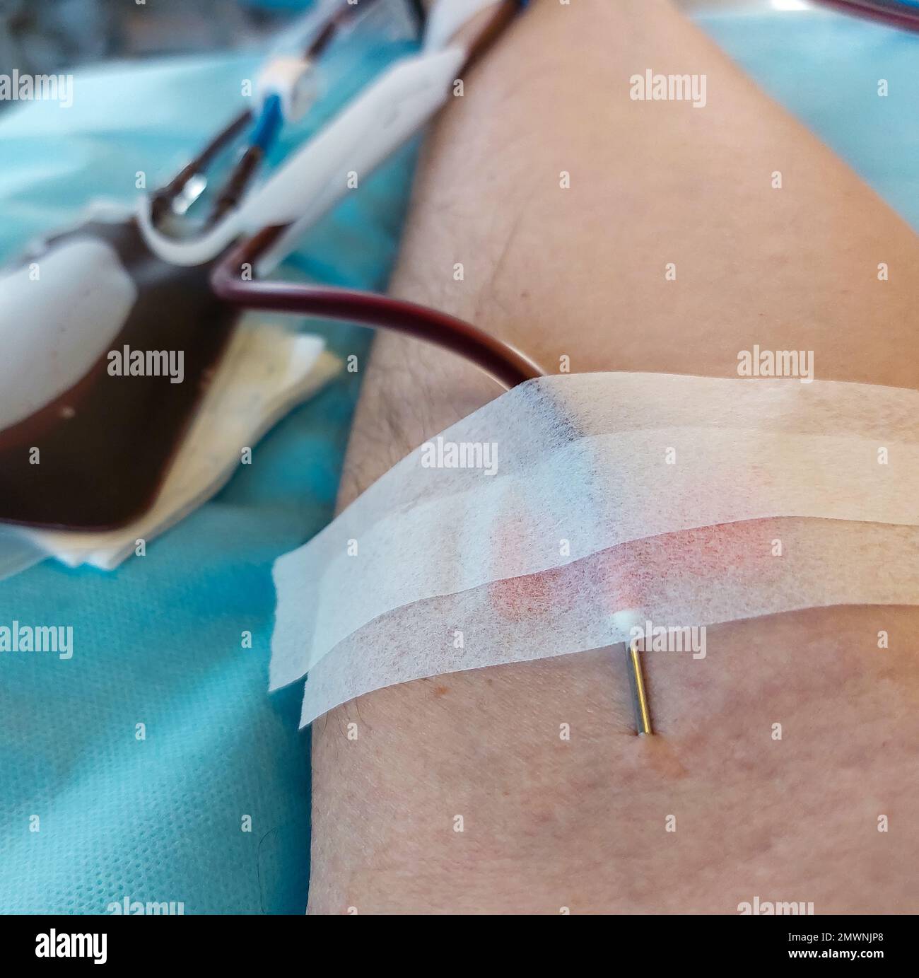 big needle stuck in blood donor arm during donation Stock Photo - Alamy