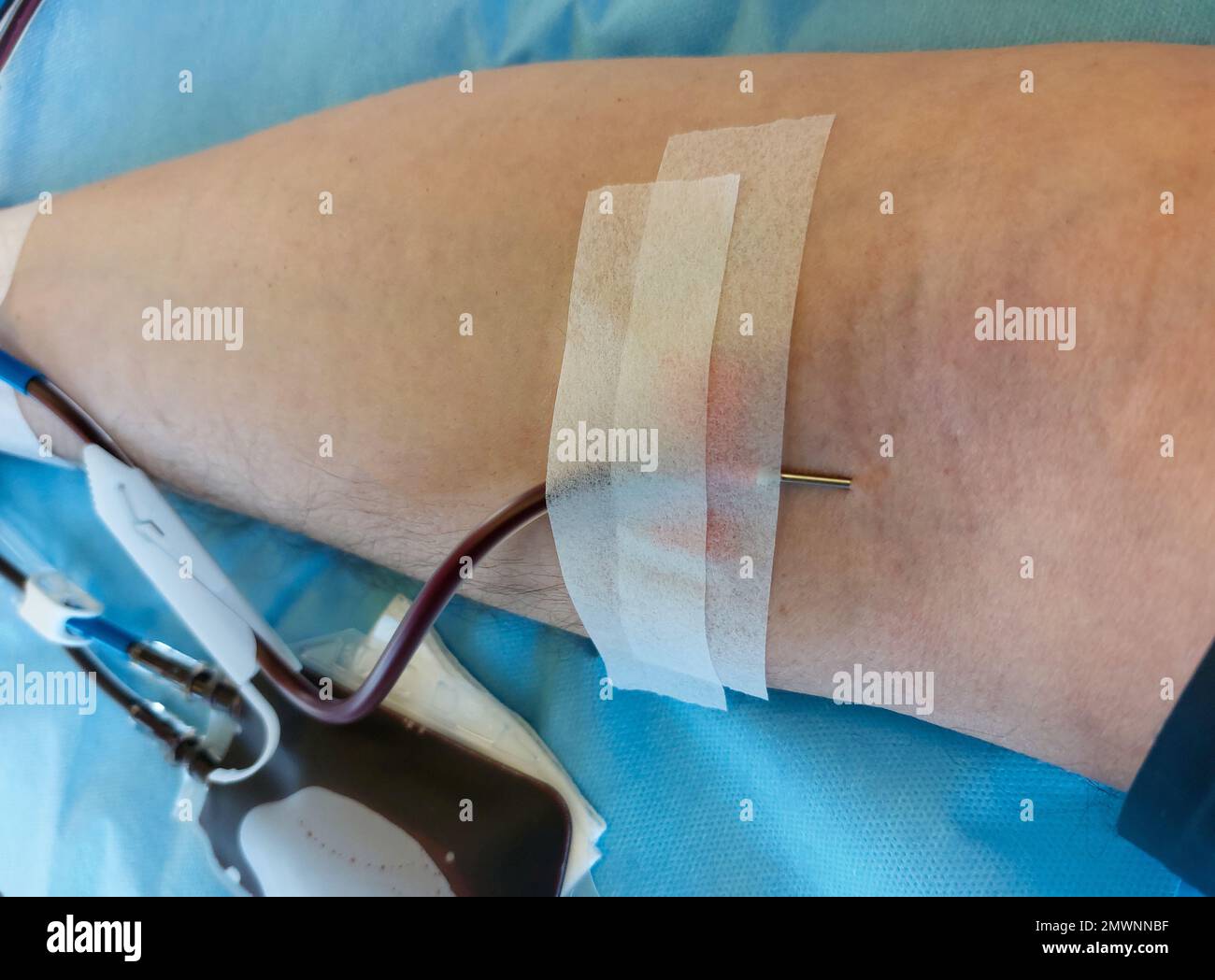 needle stuck in blood young person arm during blood transfusion at ...
