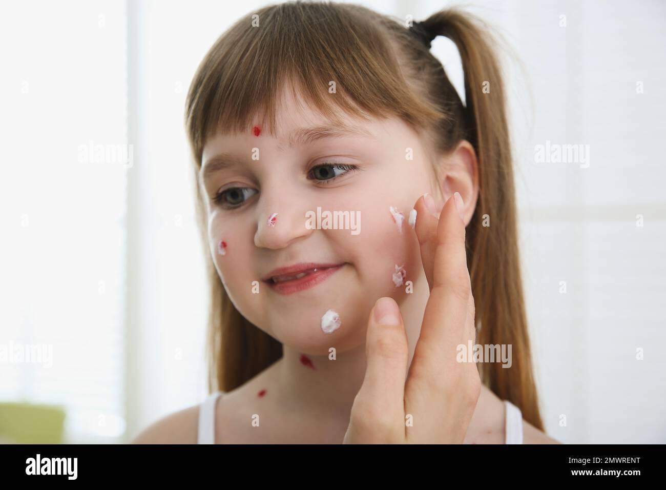 Woman applying cream onto skin of little girl with chickenpox at home ...