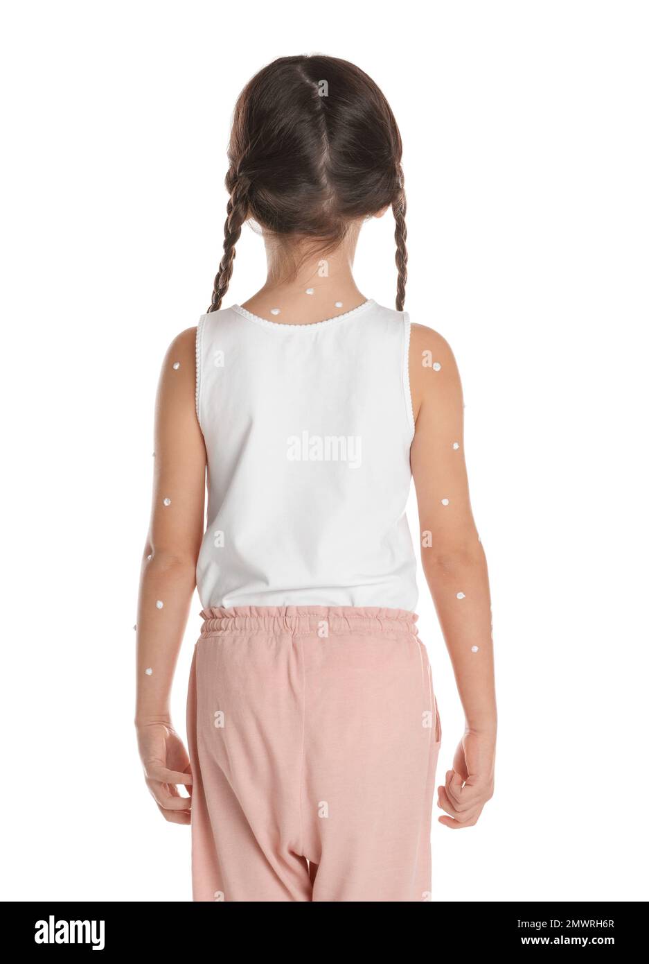 Little girl with chickenpox on white background, back view Stock Photo ...