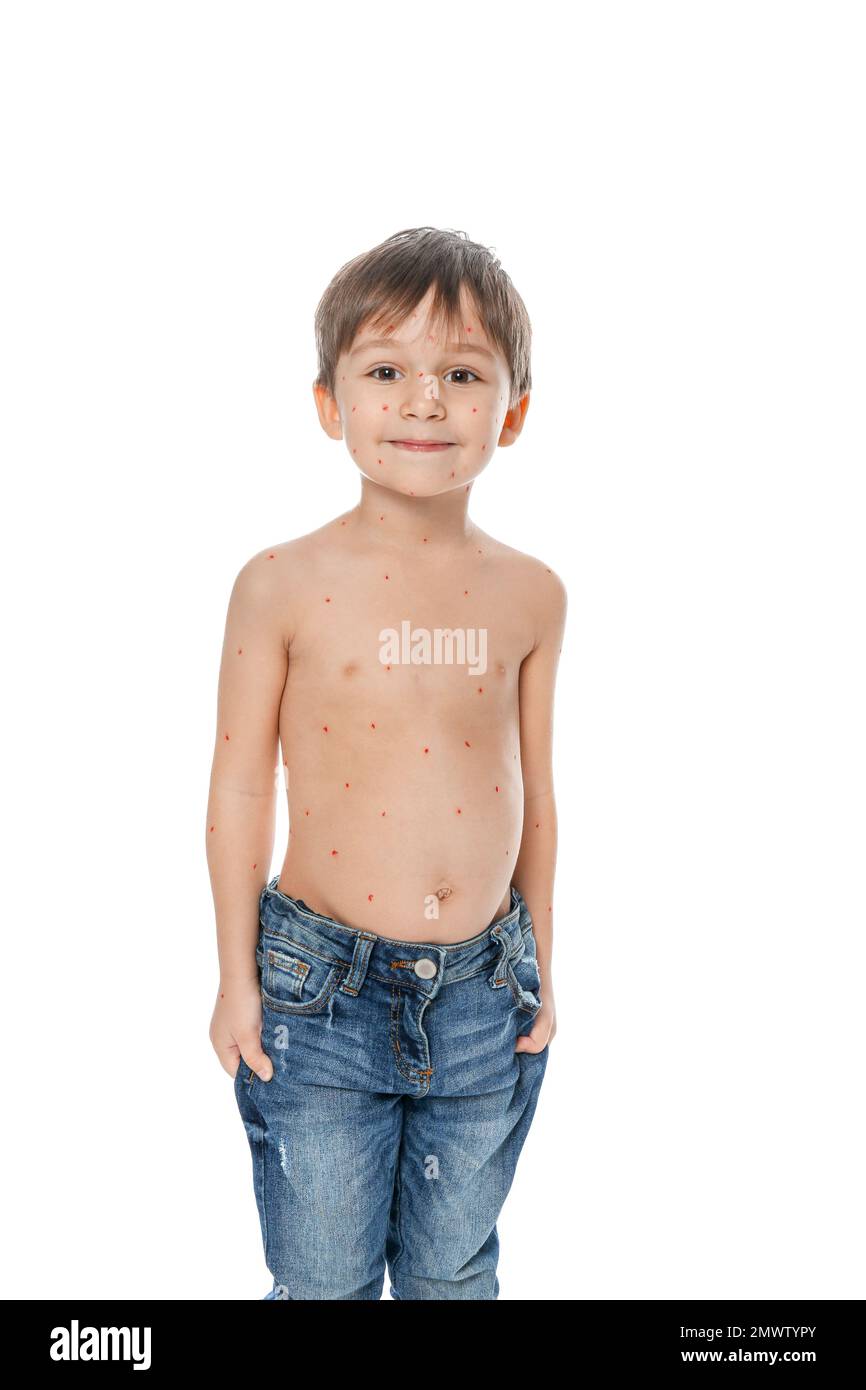 Little boy with chickenpox on white background. Varicella zoster virus ...