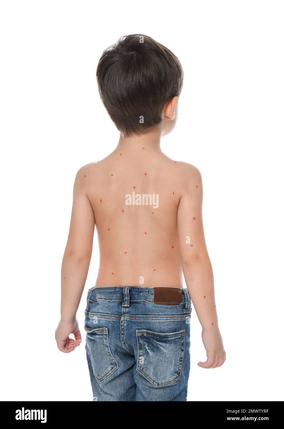 Little boy with chickenpox on white background. Varicella zoster virus ...