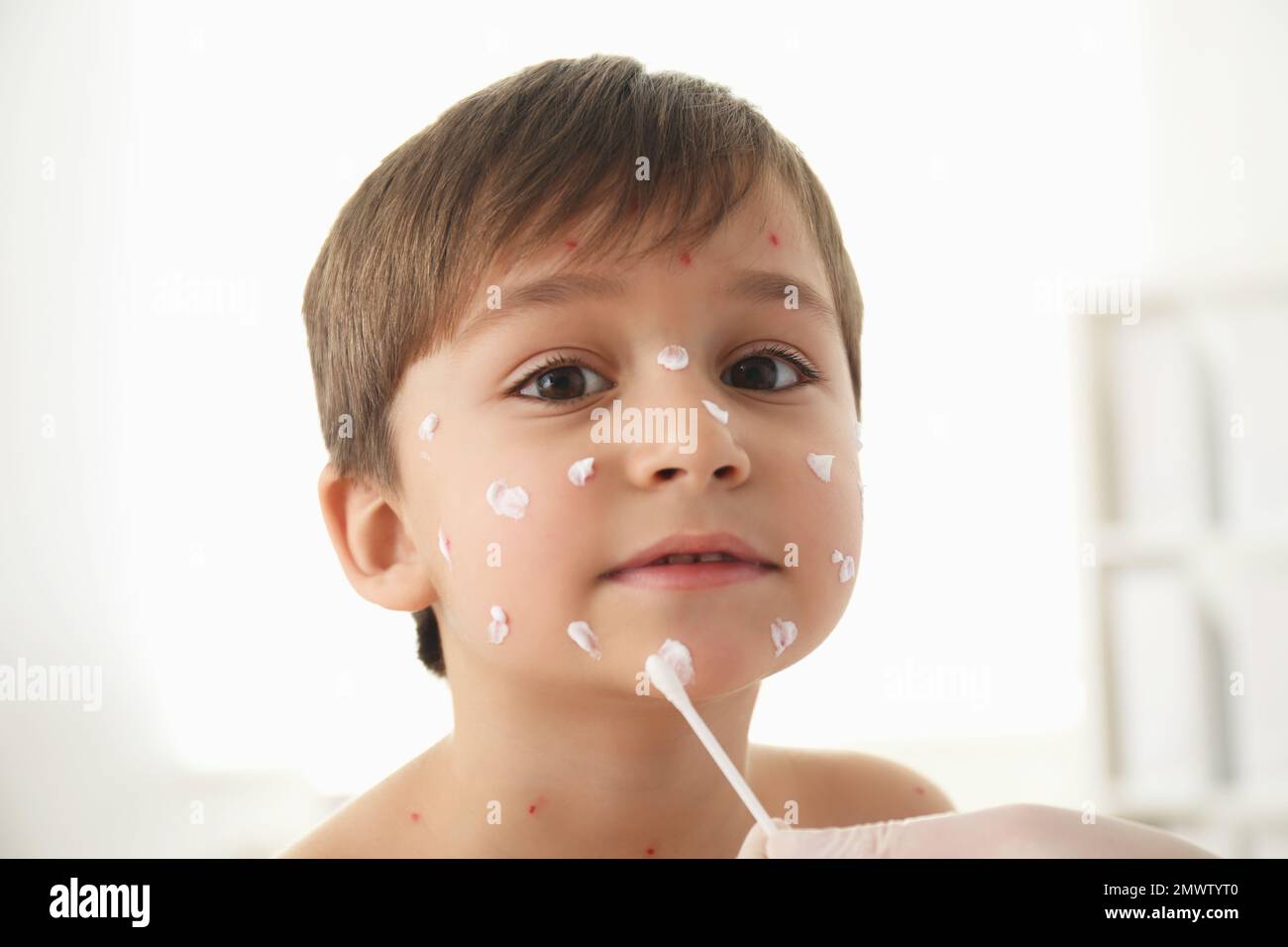 Doctor applying cream onto skin of little boy with chickenpox in clinic ...