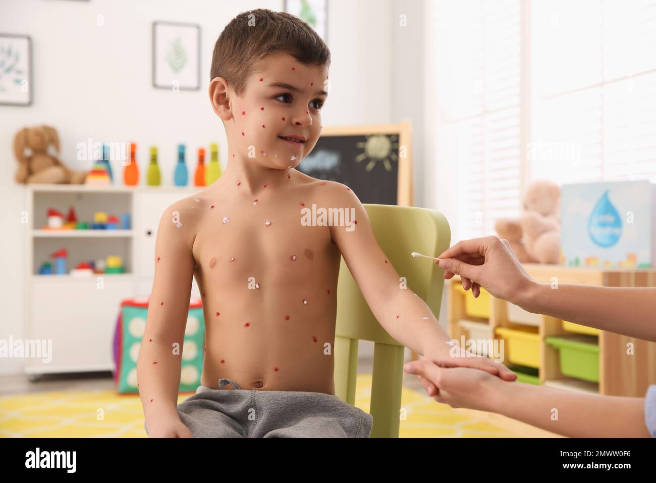 Woman applying cream onto skin of little boy with chickenpox at home ...
