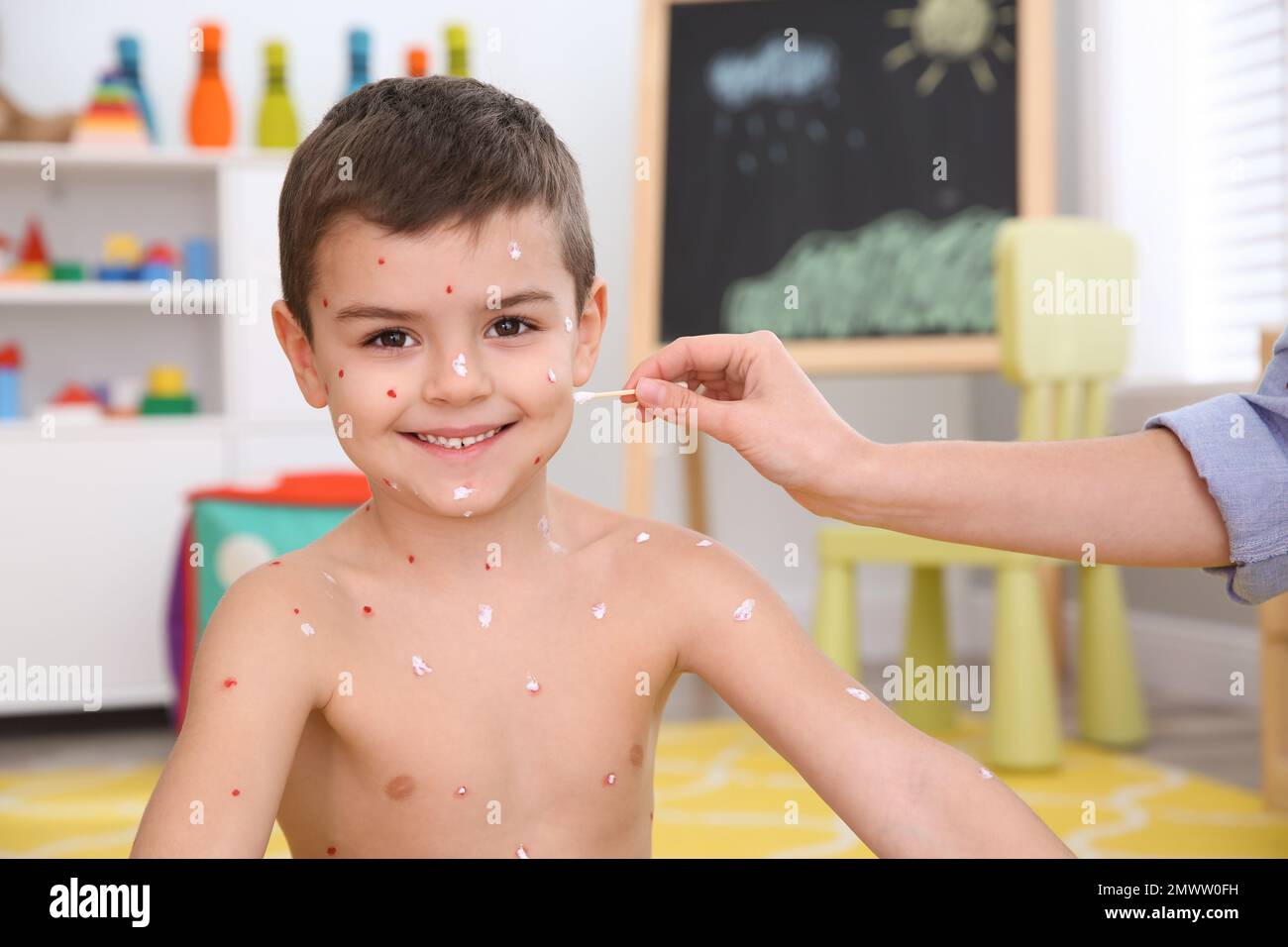 Woman applying cream onto skin of little boy with chickenpox at home ...