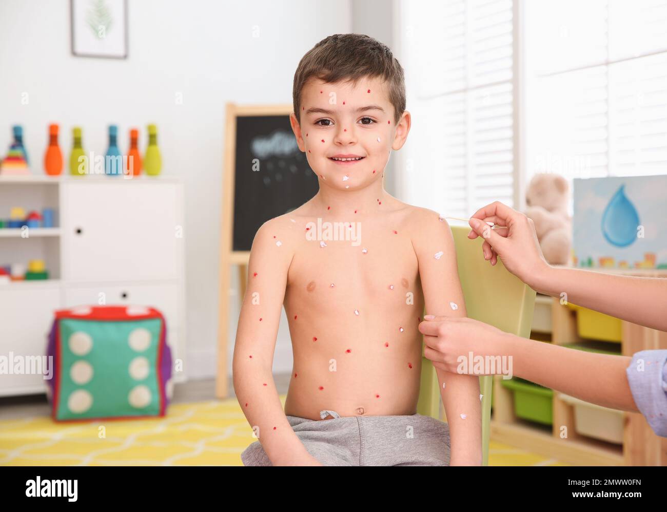 Woman applying cream onto skin of little boy with chickenpox at home ...