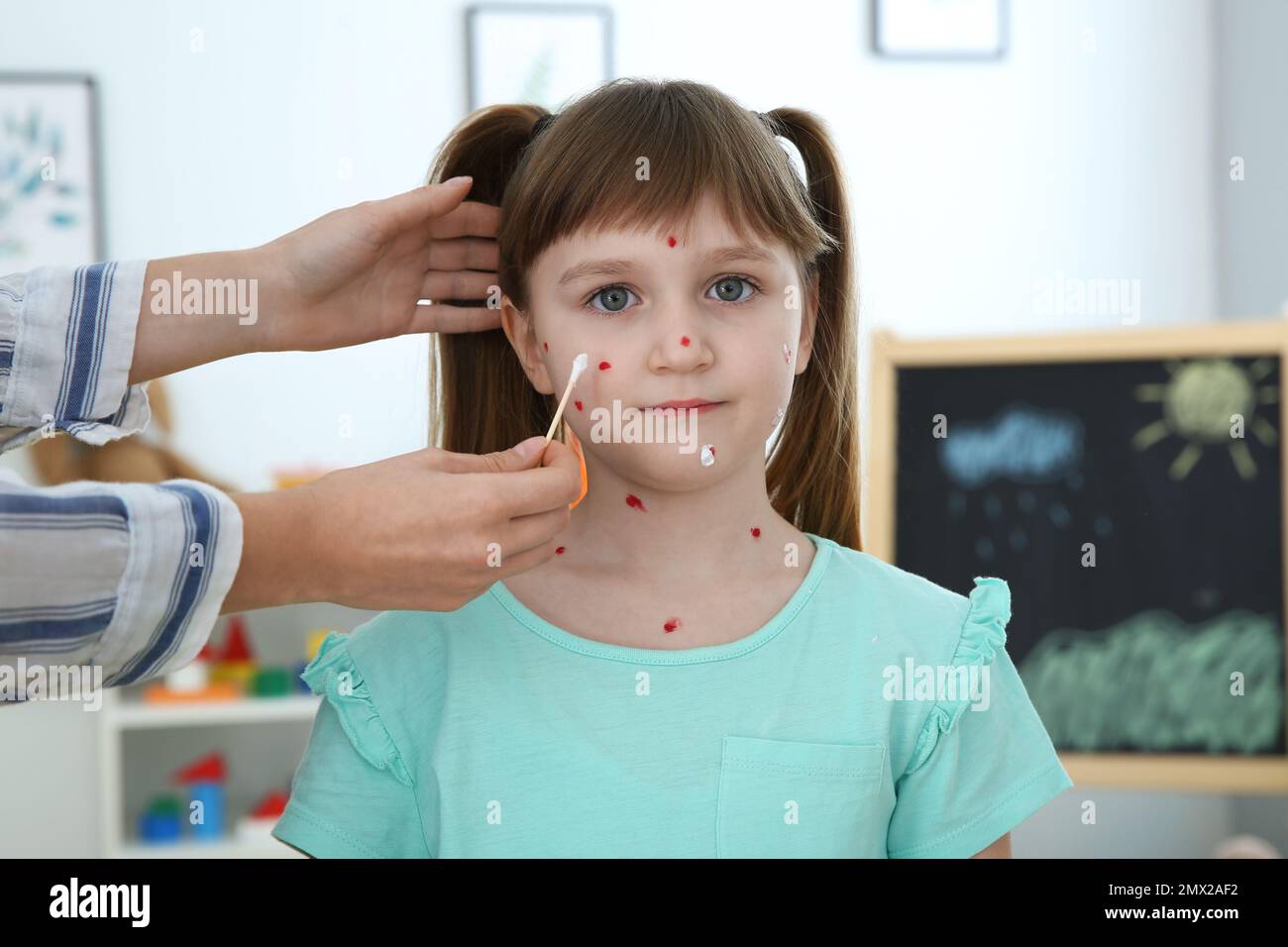 Woman applying cream onto skin of little girl with chickenpox at home ...