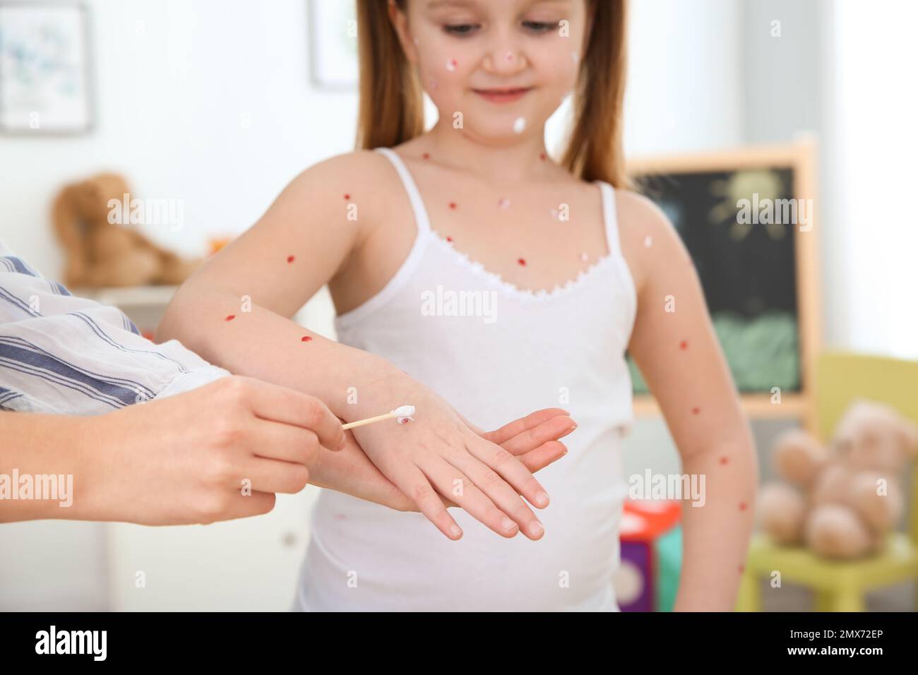 Woman applying cream onto skin of little girl with chickenpox at home ...