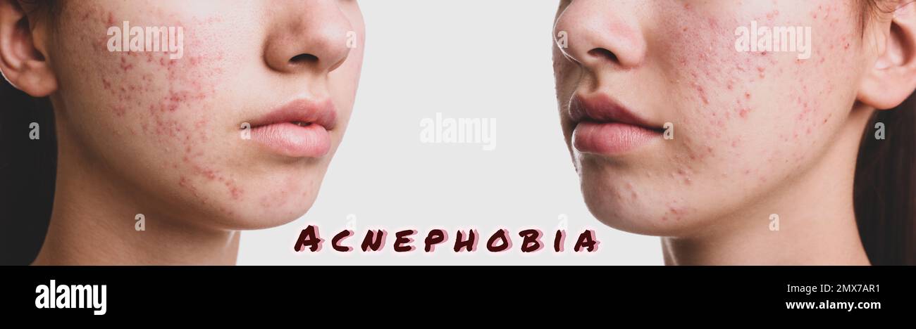 Acnephobia concept. Girl with problem skin, right and left cheeks Stock ...