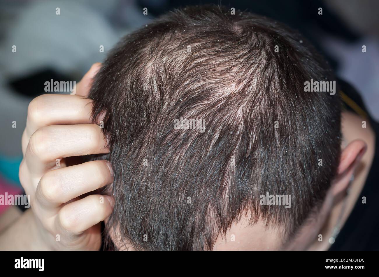 Dandruff in a man and hair loss. Male head with short hair and bald ...