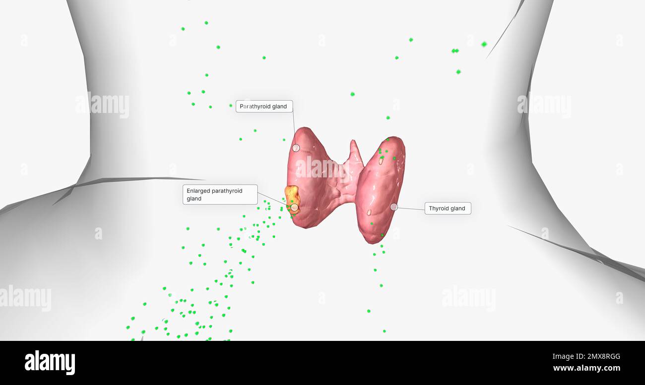 Multinodular toxic goiter hi-res stock photography and images - Alamy