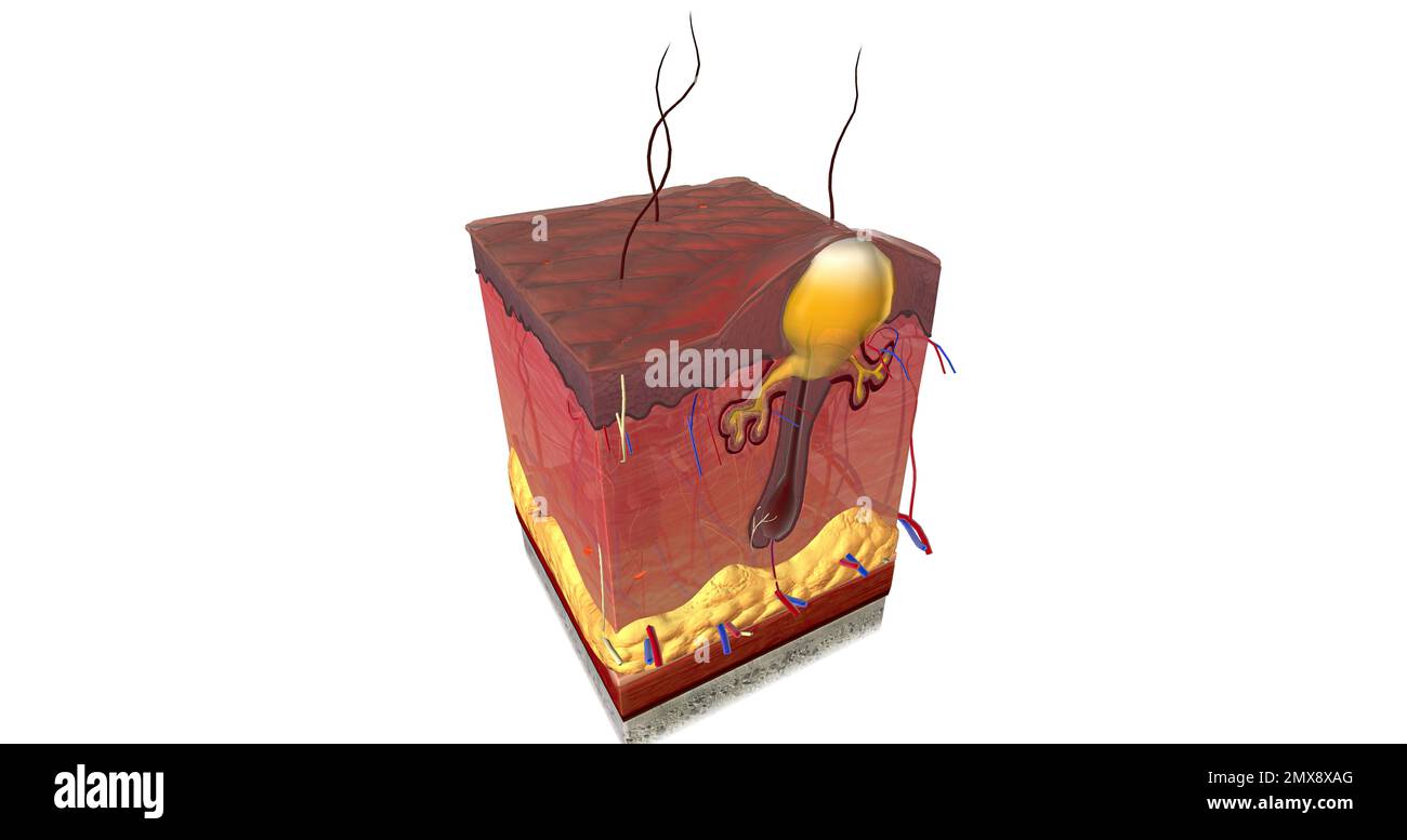 Abscess drainage hi-res stock photography and images - Alamy