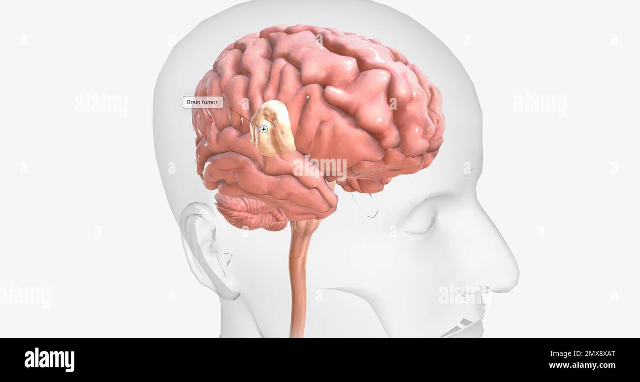 Benign brain mri hi-res stock photography and images - Alamy