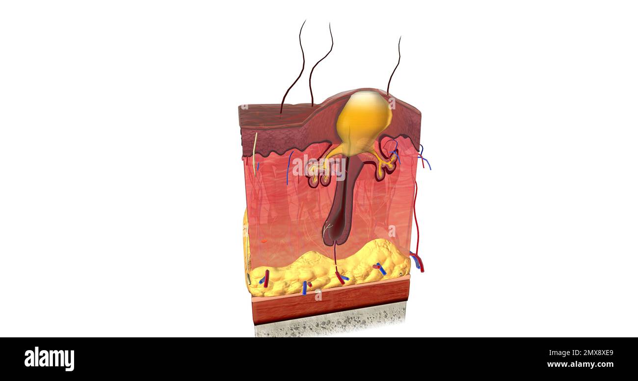 Broken abscess hi-res stock photography and images - Alamy