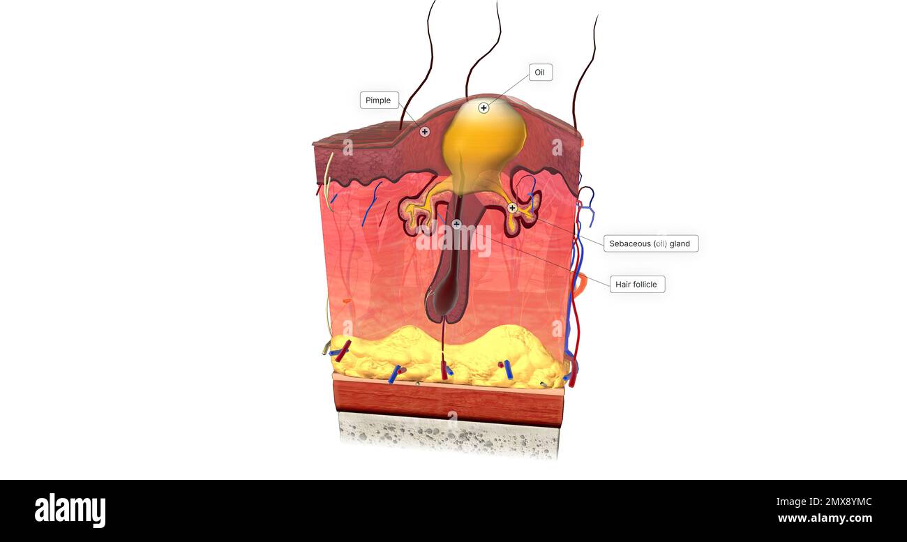 Broken abscess Cut Out Stock Images & Pictures - Alamy