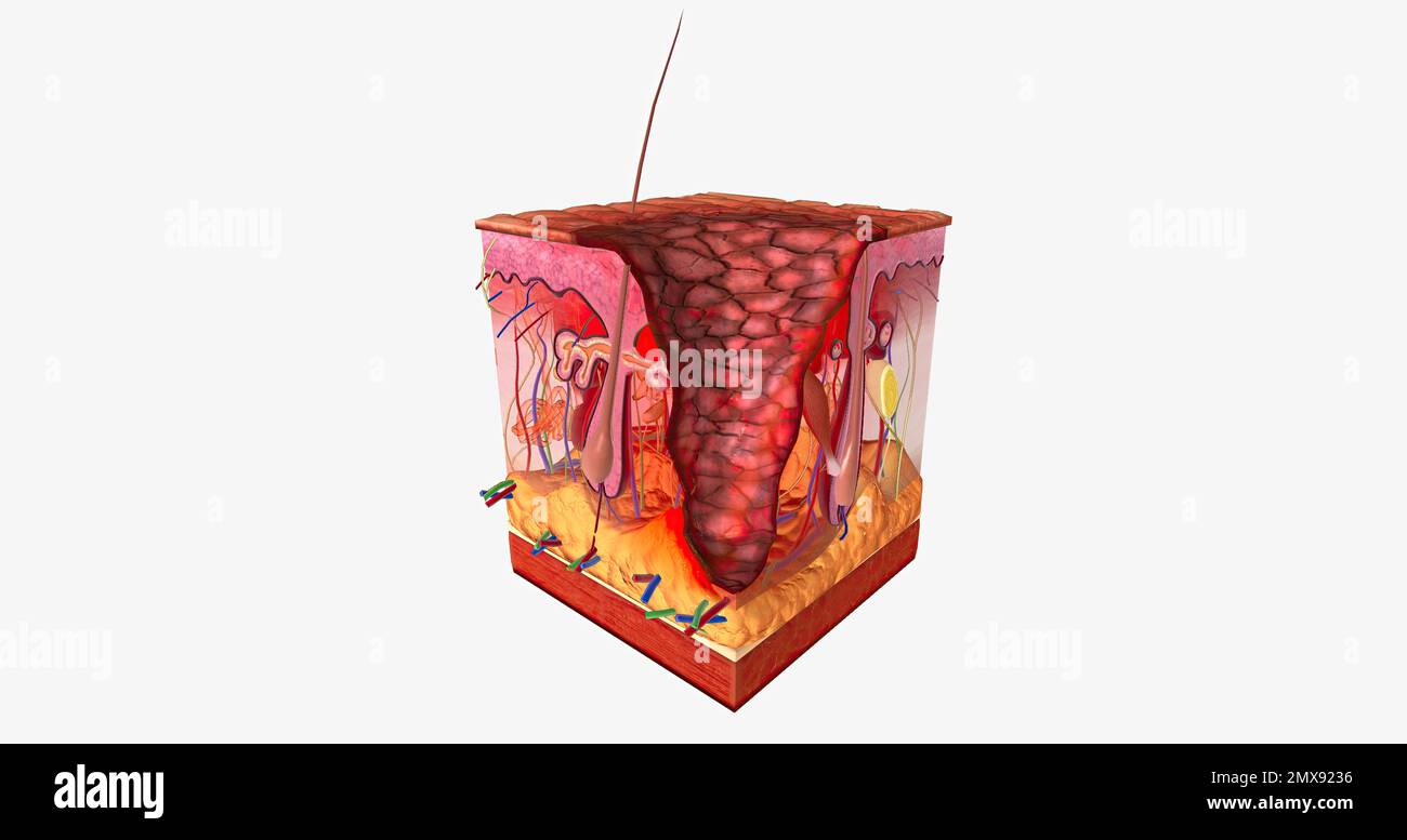 Fire burn patient treatment hi-res stock photography and images - Alamy