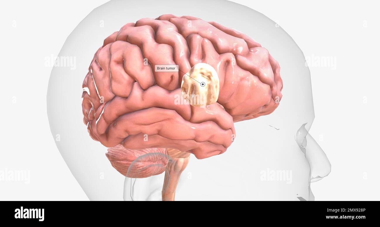 Benign brain mri hi-res stock photography and images - Alamy