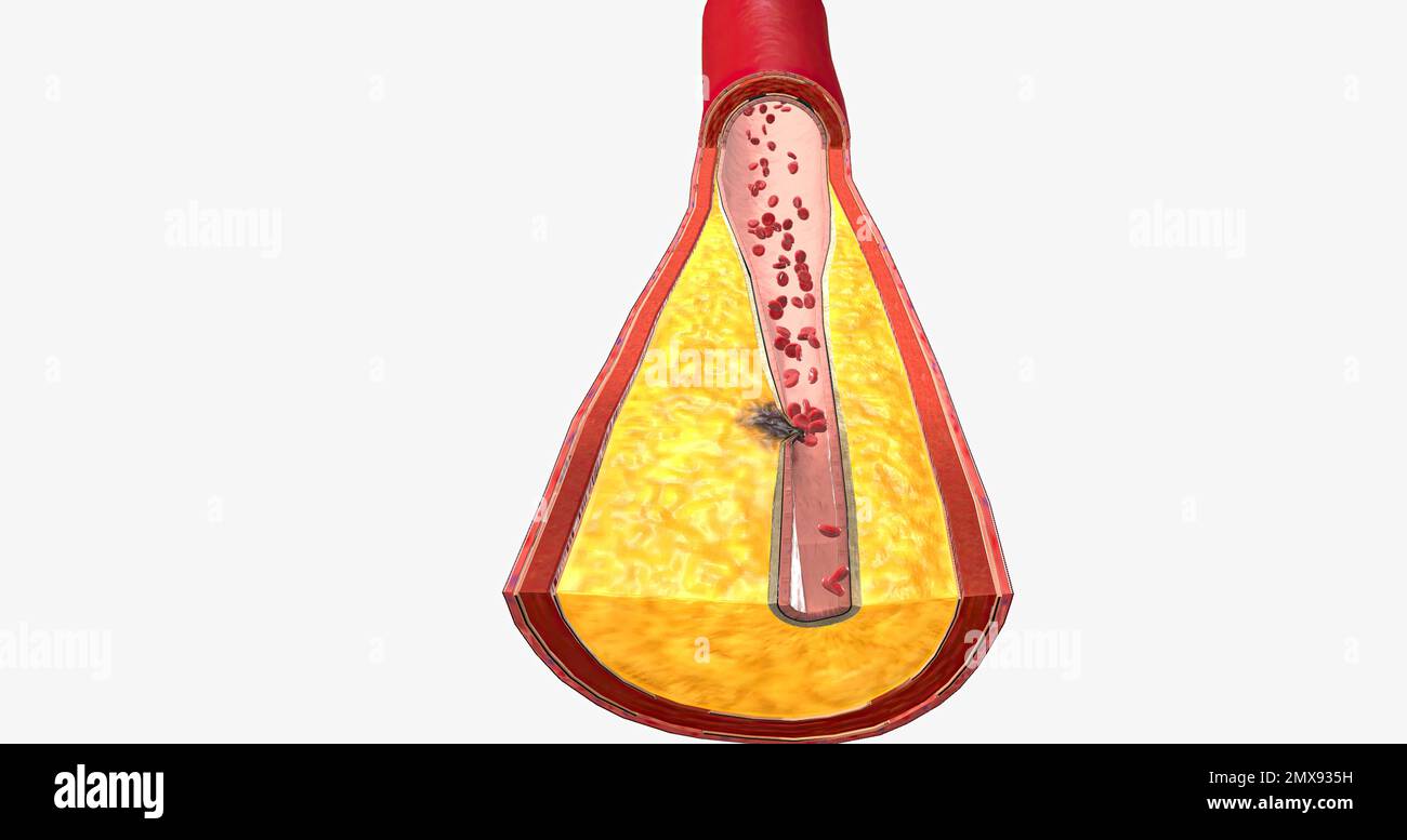 Healthy and atherosclerotic arteries hi-res stock photography and ...