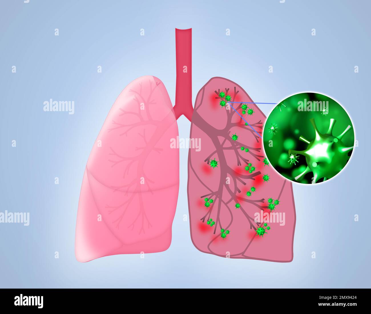 Illustration of human lungs affected with disease on light blue ...