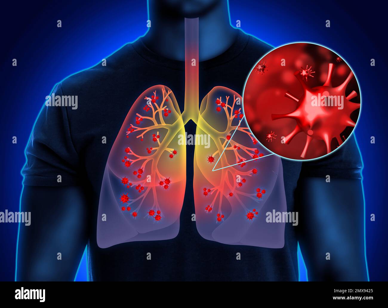 Man with diseased lungs on dark background. Illustration Stock Photo ...