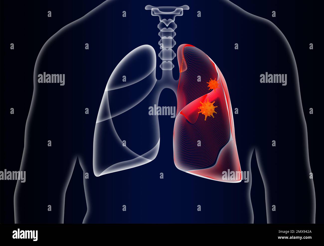 Man with diseased lungs on dark background. Illustration Stock Photo ...