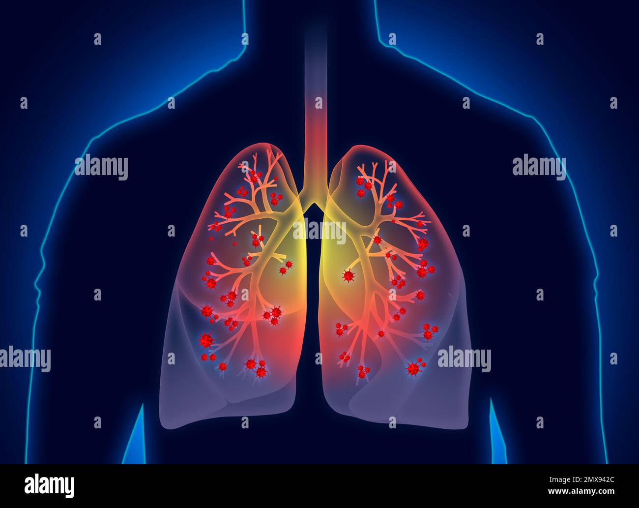 Man with diseased lungs on dark background. Illustration Stock Photo ...