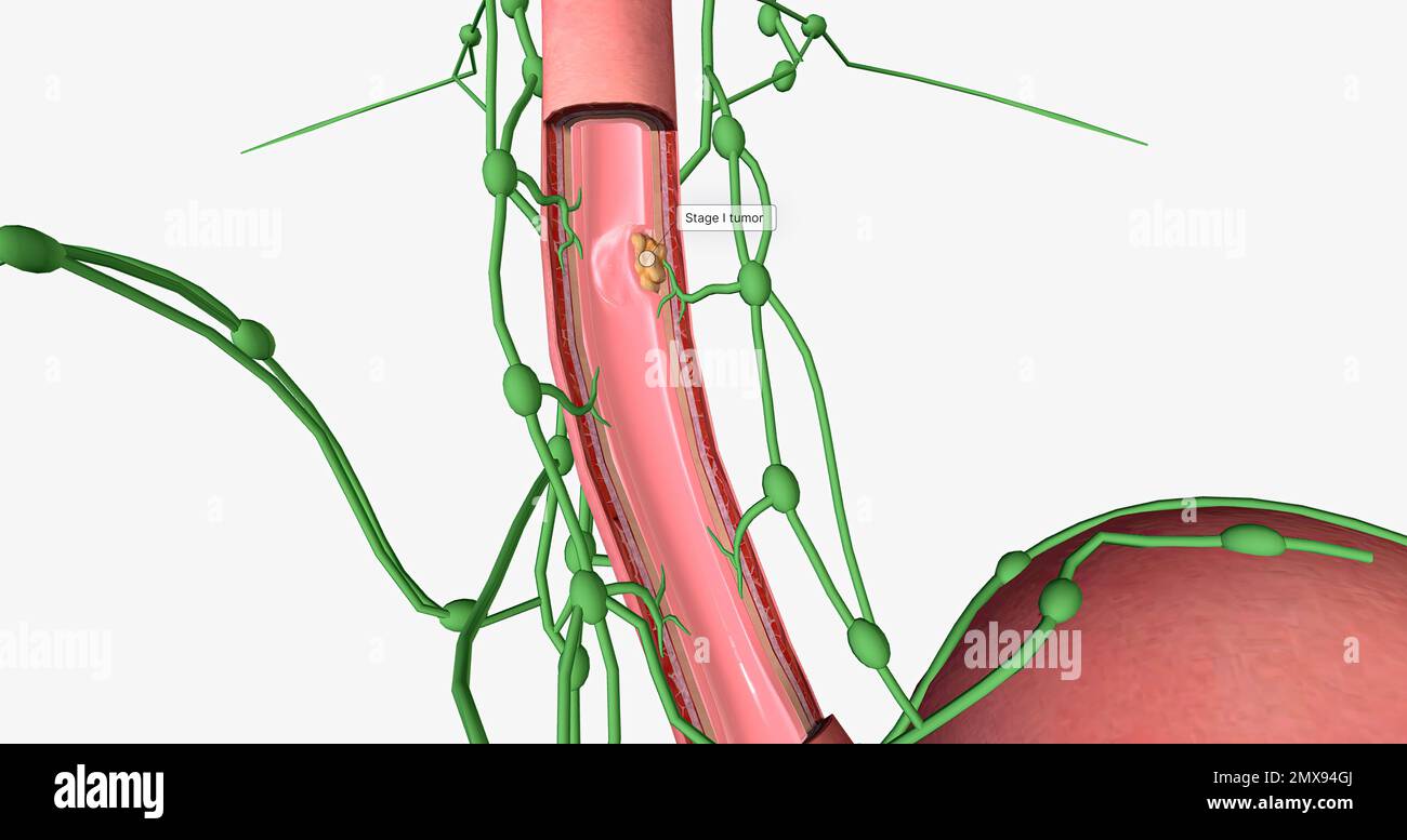Esophageal mucosa hi-res stock photography and images - Alamy