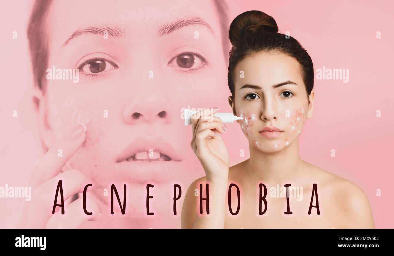 Teenage girl with problem skin applying cream on light pink background ...