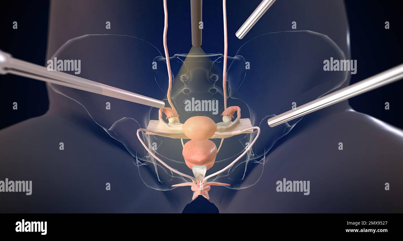 Surgical procedure diagram hi-res stock photography and images - Alamy