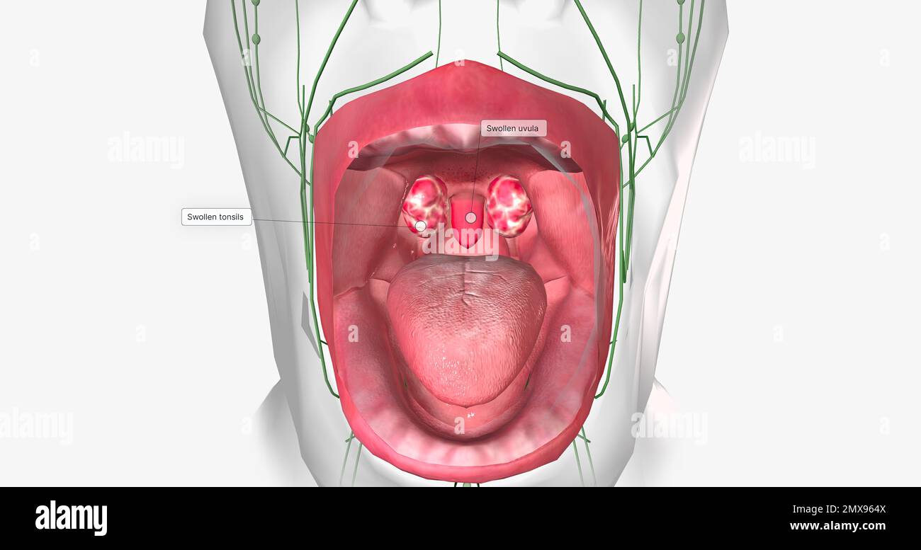 Strep a infection hi-res stock photography and images - Alamy Strep a infection hi-res stock photography and images - Alamy