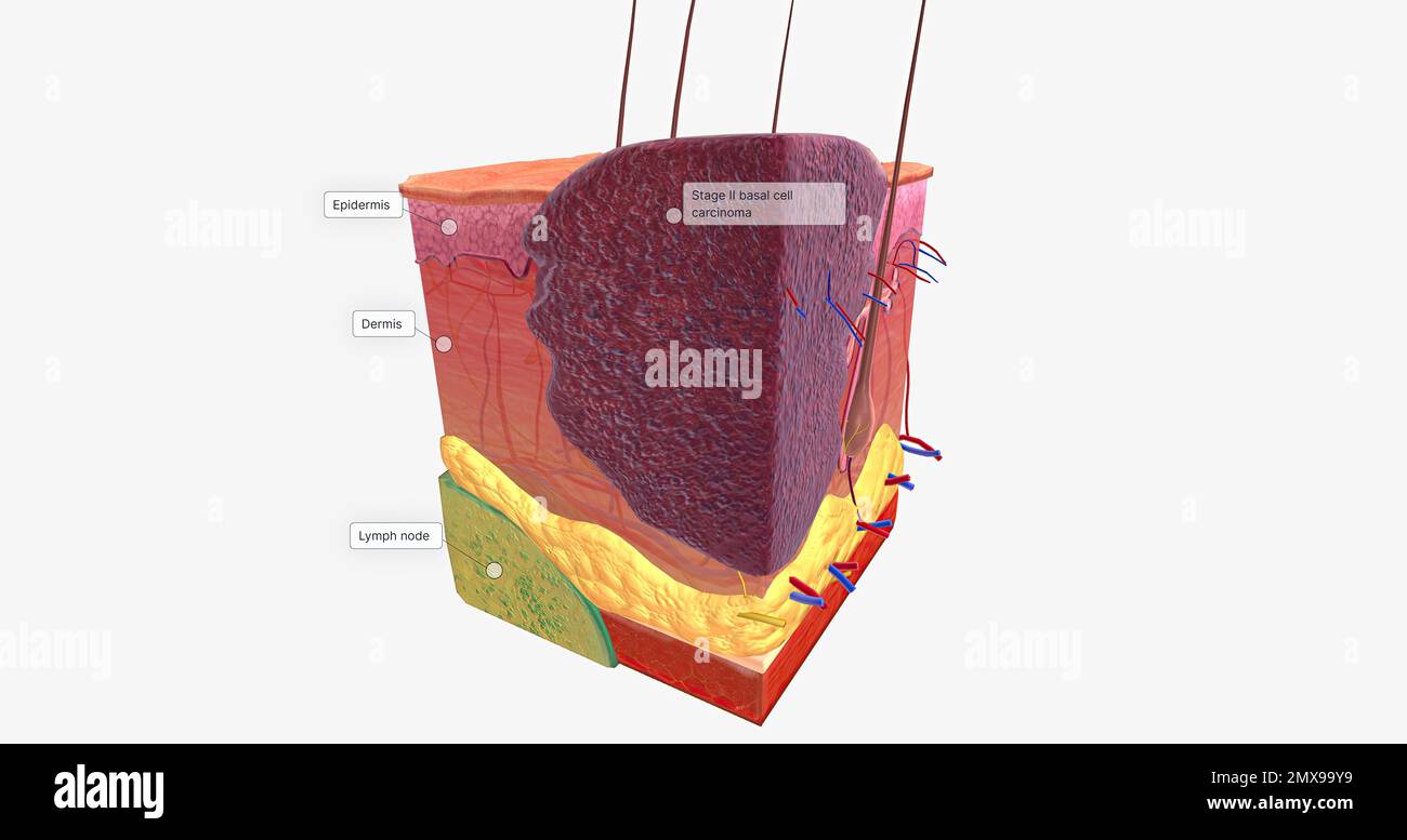 Basal cell skin cancer Cut Out Stock Images & Pictures - Alamy