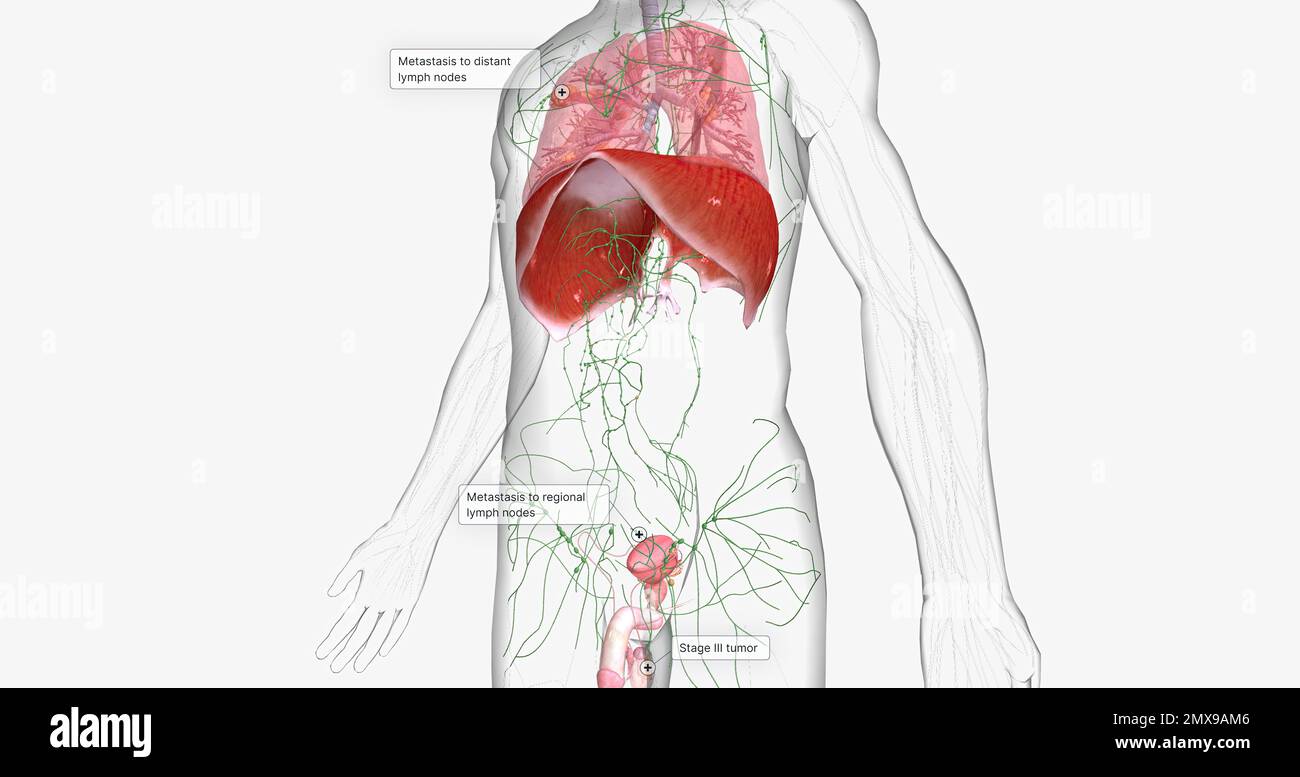 Disease of male genital organ hi-res stock photography and images - Alamy