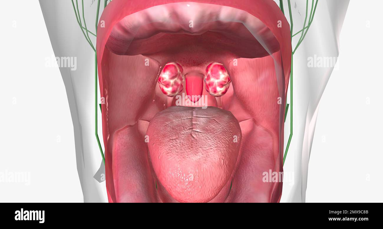 Strep a infection hi-res stock photography and images - Alamy Strep a infection hi-res stock photography and images - Alamy